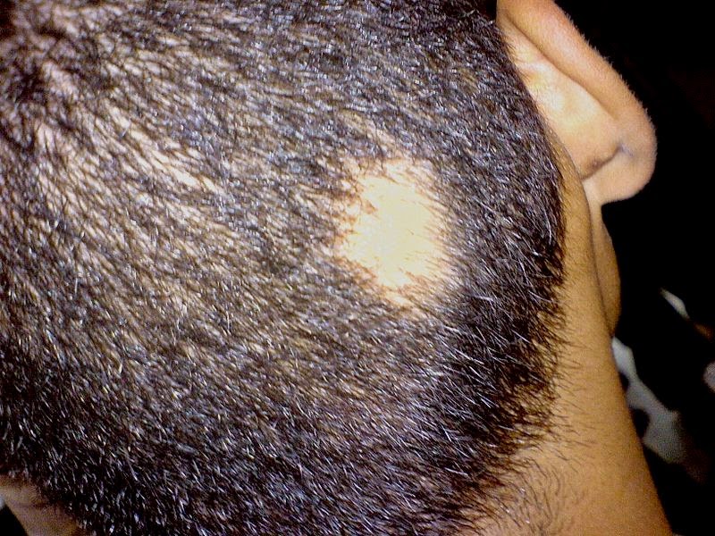What is alopecia areata - Definition of alopecia areata | the dynamic ...