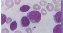 FICHERO HEMATOLOGIA : Prolinfocito