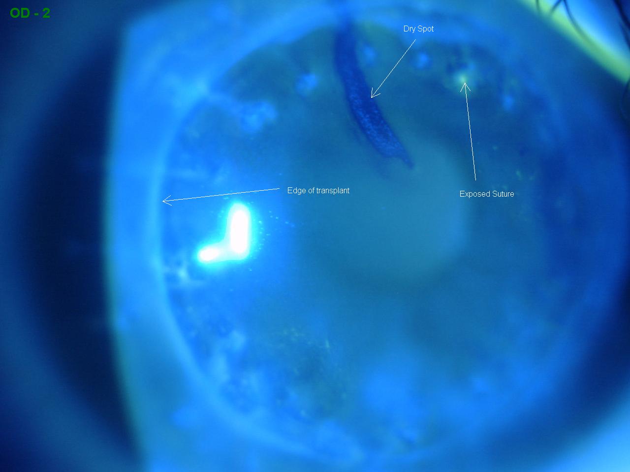 Sonoran Desert Eye Center: CORNEAL TRANSPLANT (PKP OR PENETRATING ...