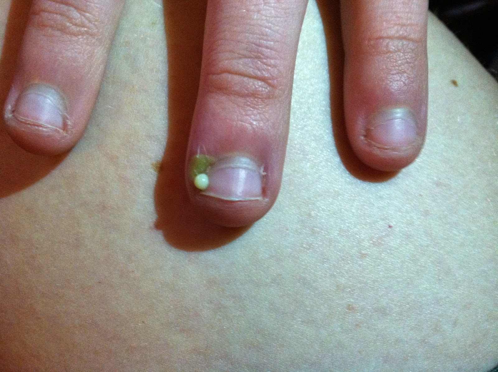 Call Me Irresponsible: Lucy's Finger Infection (warning- kinda gross)