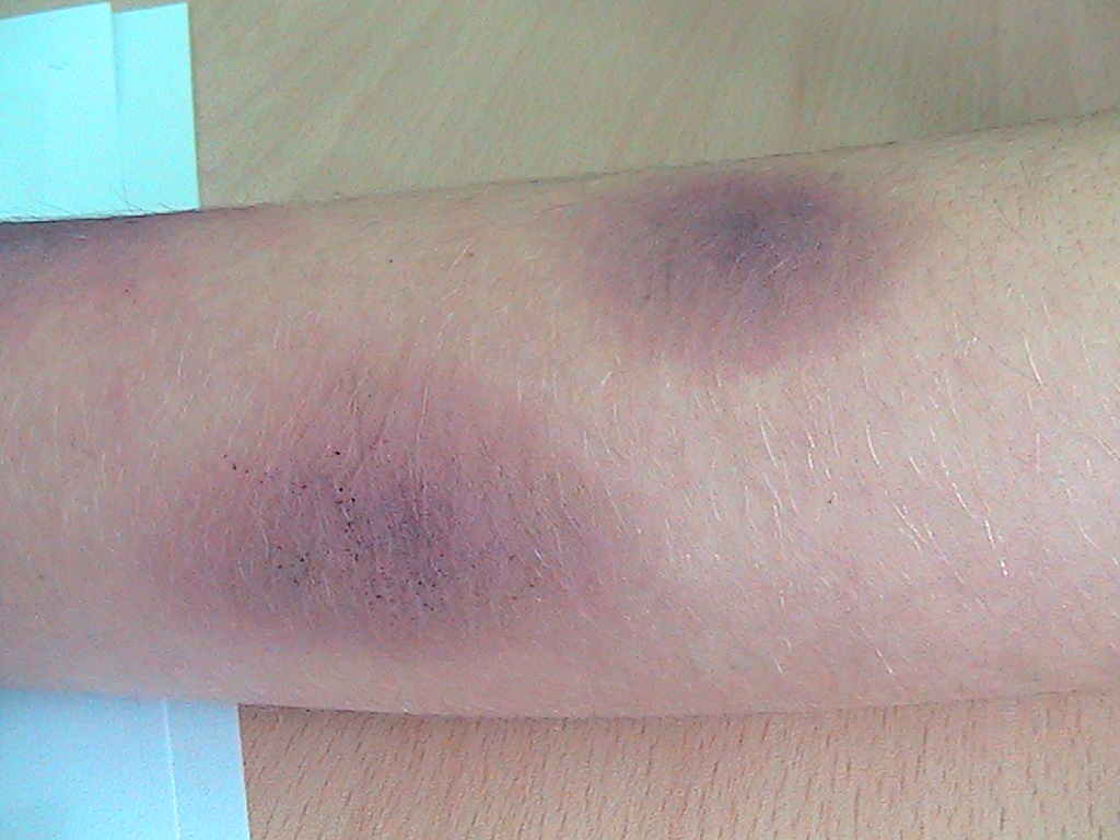 Penance: Fake Bruise Experimentation