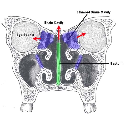 Blood Thinner Use and Sino-Nasal Surgery (Septum and Sinus Surgery ...