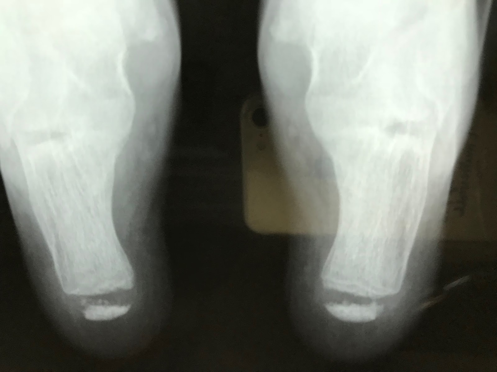 VIETNAMESE MEDIC ULTRASOUND: CASE 466:CHILDREN HEEL PAIN : A SEVER'S ...