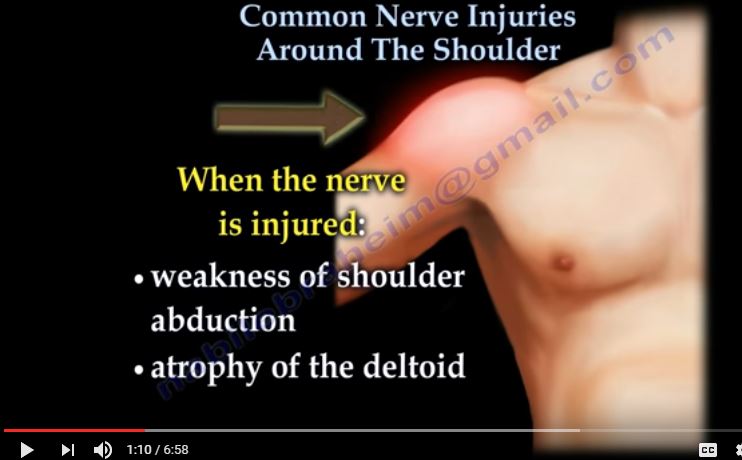 Shoulder Nerve Injury - DNB Orthopaedics MS Orthopedics MRCS Exam GUIDE ...