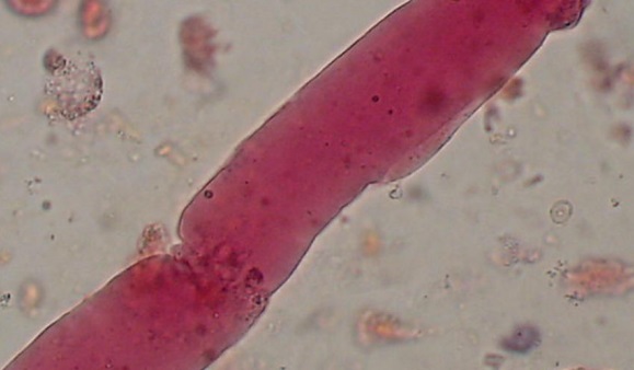 Sedimento urinario: Cilindros