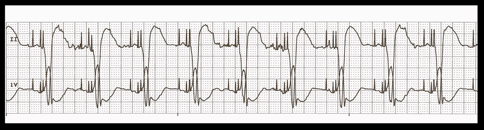 EKG Rhythm Quiz 285