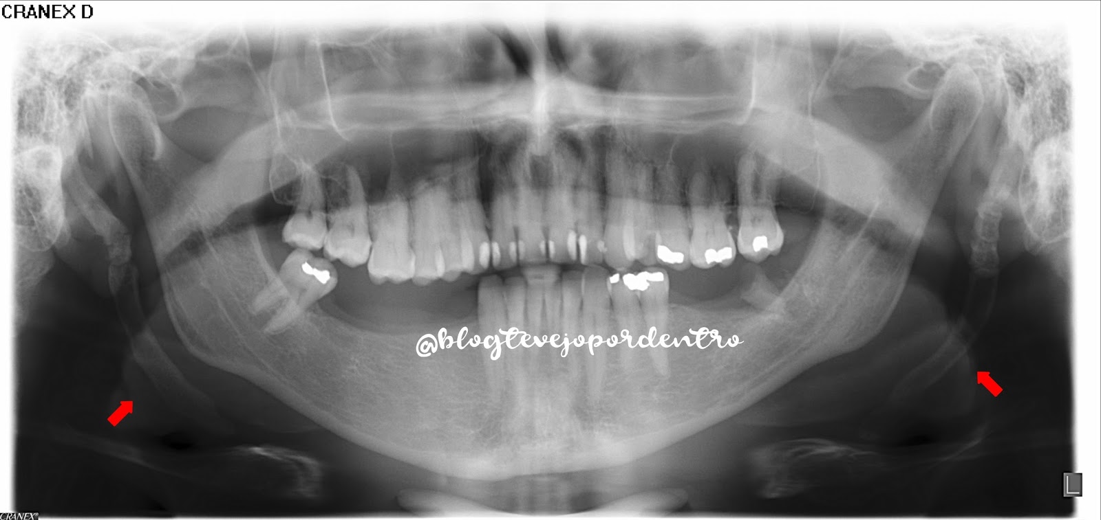 "Te vejo por dentro": Prolongamento e/ ou calcificação do processo ...