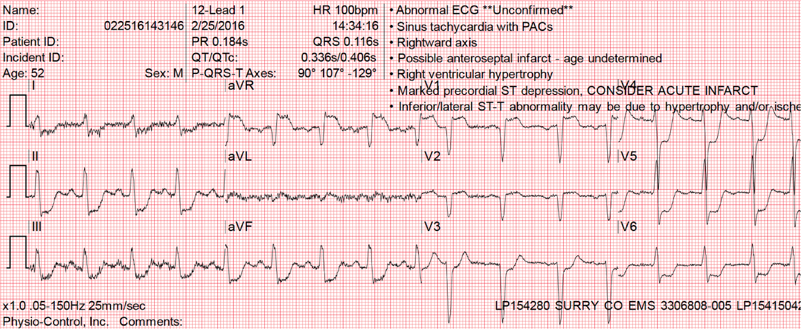 Elevation in aVR, LMCA occlusion : r/EKGs