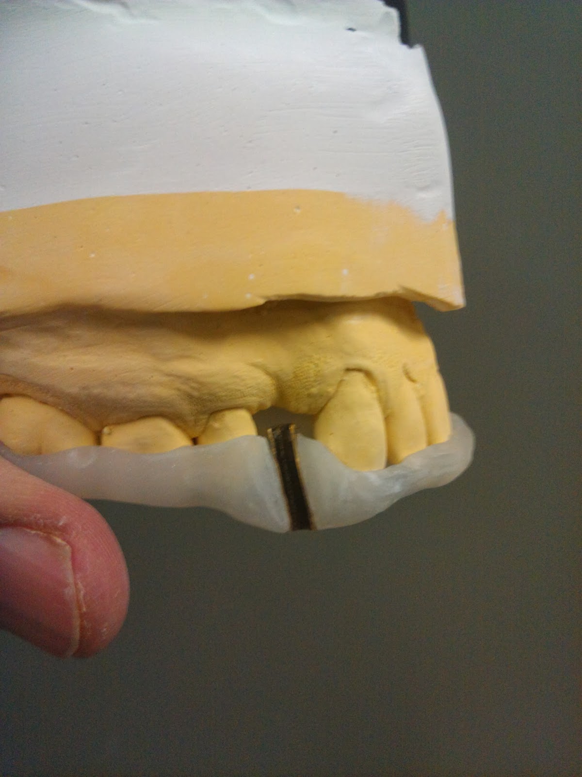 Fourth-Molar: Surgical Guide Techniques - Triad & Vacuuform