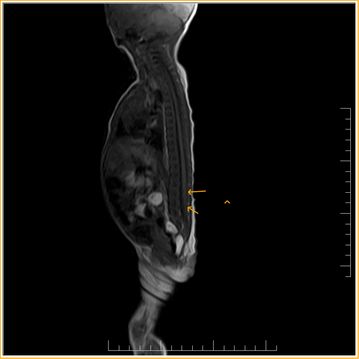 Tethered Spinal Cord - Sumer's Radiology Blog
