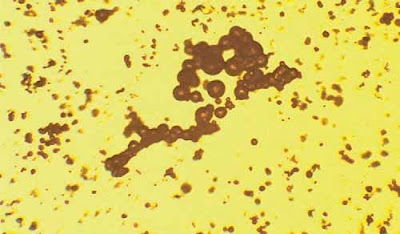 Atlas of Crystals found in alkaline urine | Free Medical Atlas