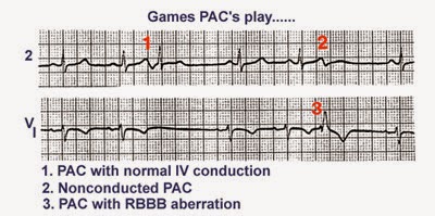 Premature Atrial Contraction / Atrial Ekstrasistol | INA - ECG