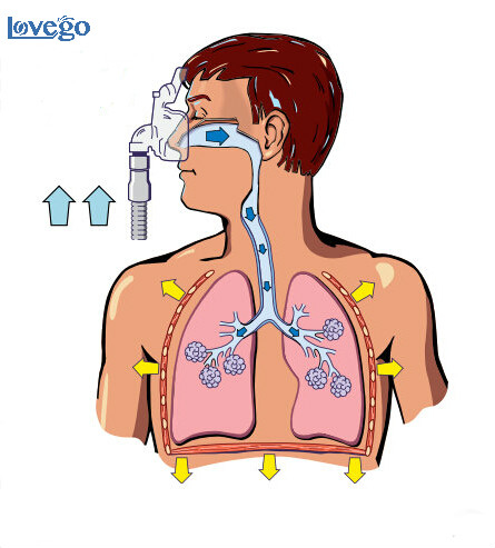 Lovego COPD Service: CPAP and COPD & Sleep Apnea