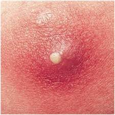 Salep Antibiotik Untuk Mengobati Bisul: Cara Tradisional Agar Bisul ...