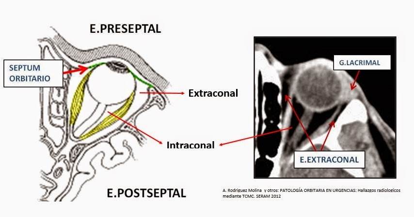 ESPE 202 - 2014: Anatomía y patologías de la cavidad orbitaria