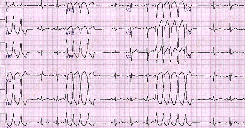 GO-EM: An Approach: NonSustained Ventricular Tachycardia