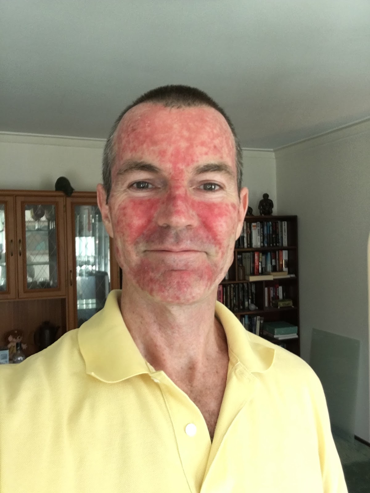 Efudix Treatment: Day 15 - The last week starts!