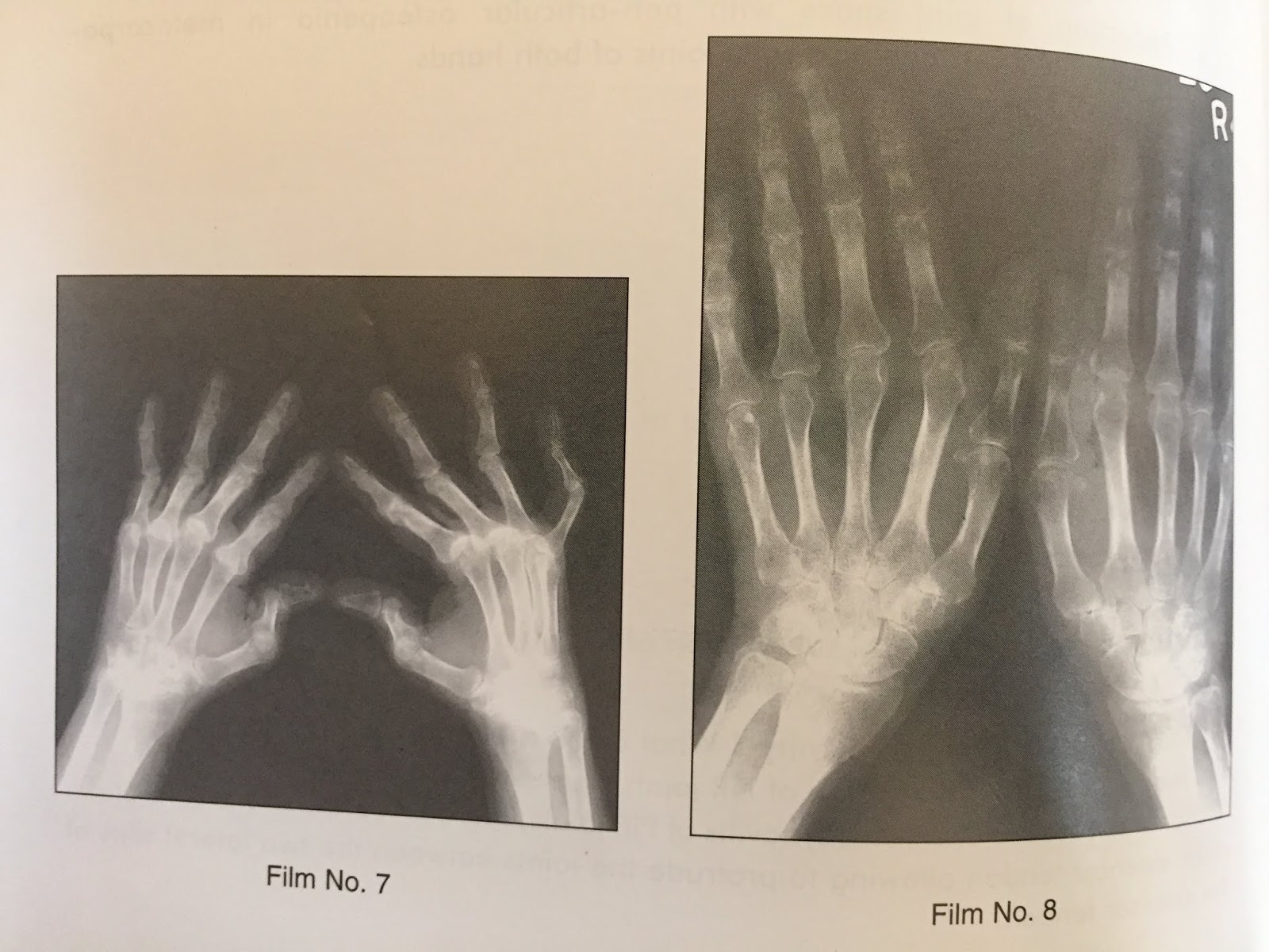 XRAYS OF RHEUMATOID ARTHRITIS