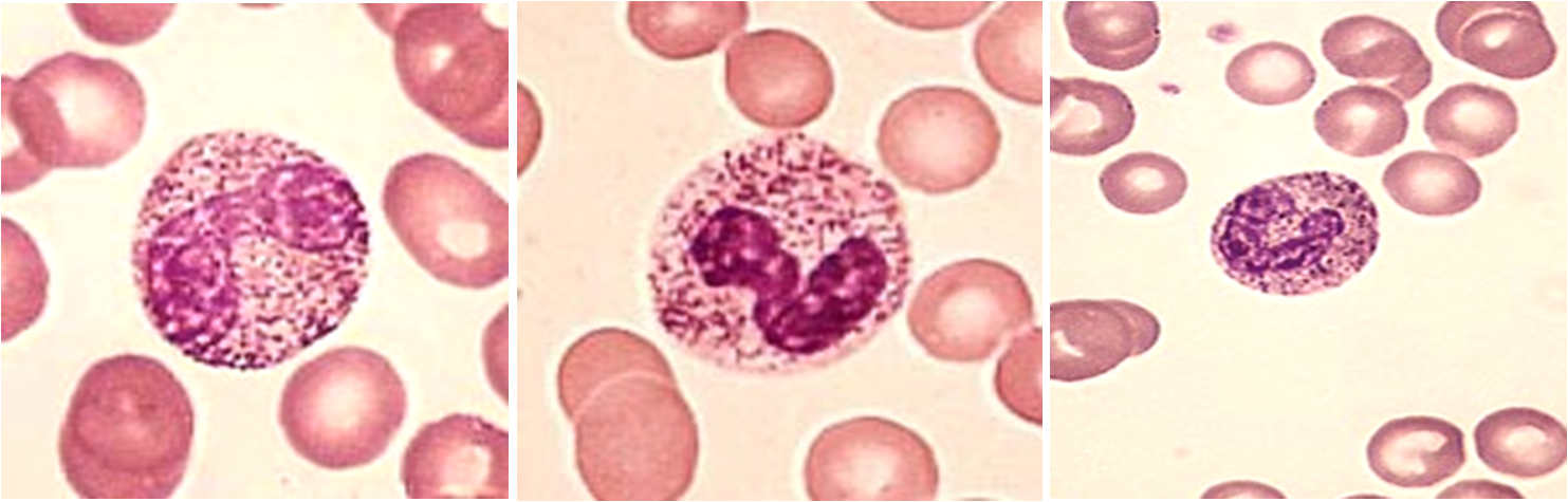 FICHERO DE HEMATOLOGIA : ANORMALIDADES DE LOS NEUTROFILOS