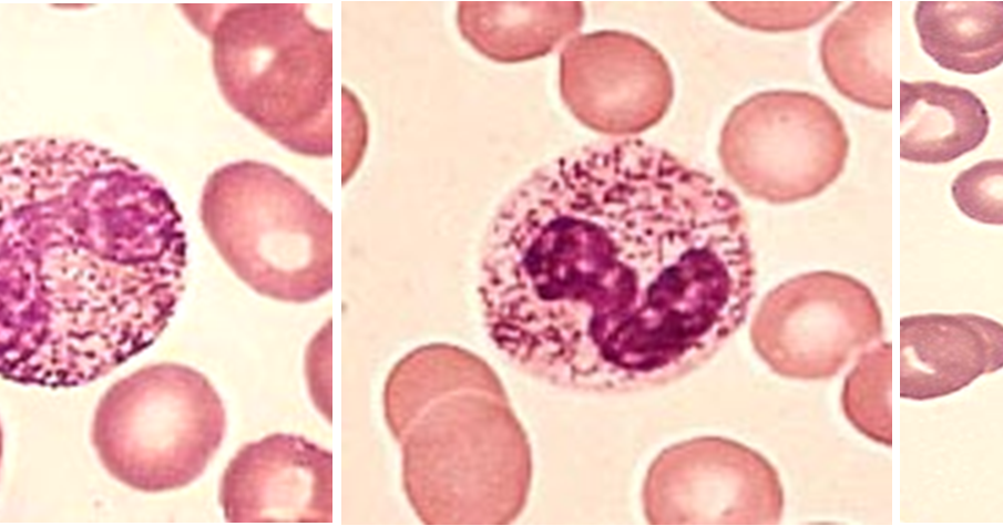 FICHERO DE HEMATOLOGIA : ANORMALIDADES DE LOS NEUTROFILOS