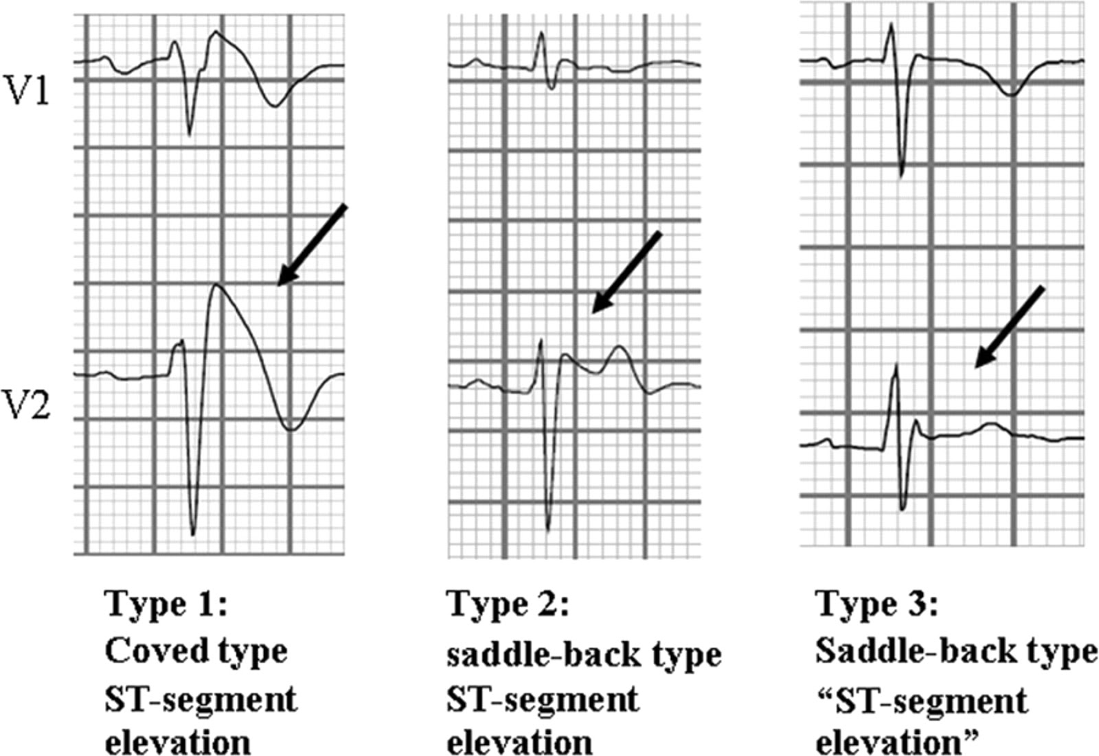 Dr Han Naung @ Henry Han : Electrophysiology and Heart Rhythm : Brugada ...