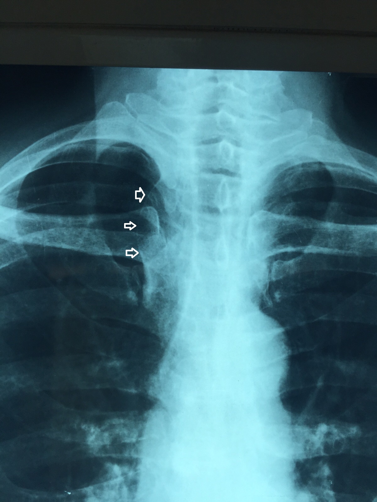 Chest Medicine Made Easy-Dr Deepu: CHEST RADIOLOGY - A CASE OF AZYGOUS LOBE