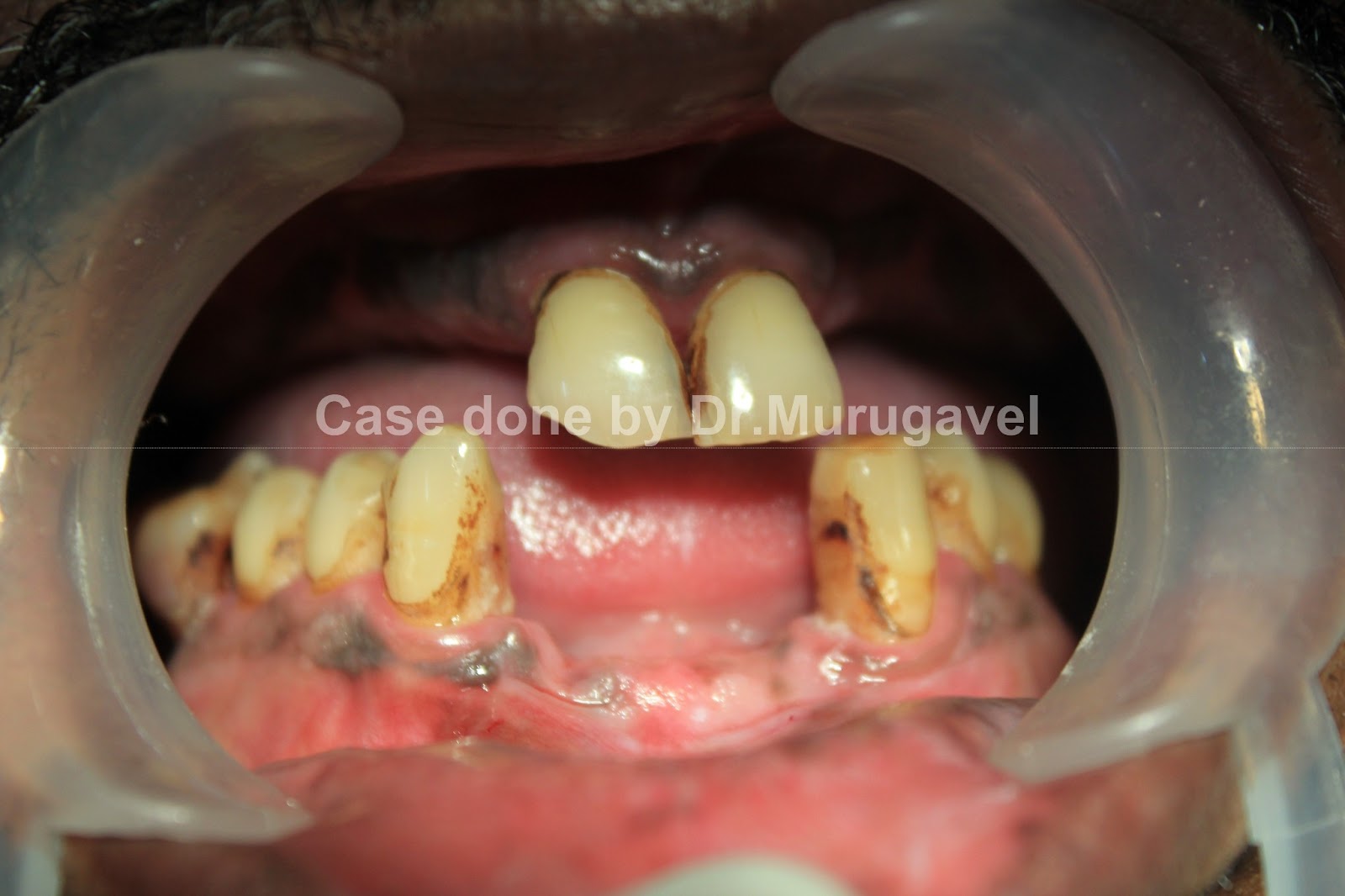 DR Murugavel's dental implant course: Replacement Of Missing Lower ...