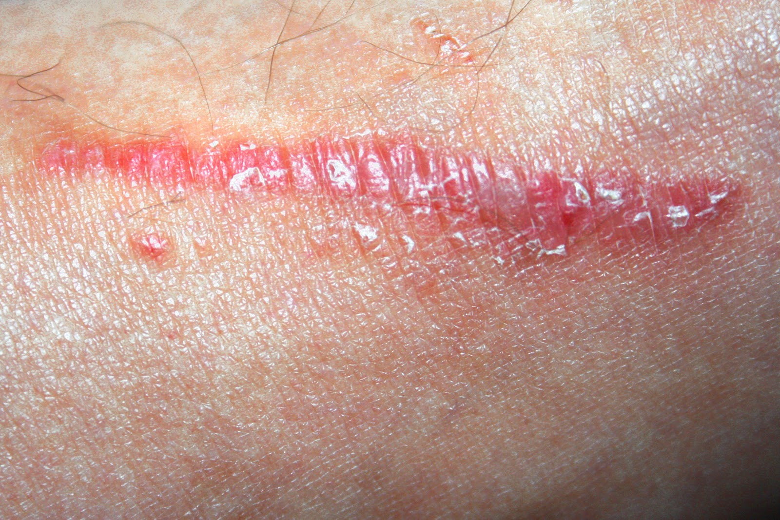 Aussteigen, Einsteigen, Aufsteigen: Saure Käfer und Colgate