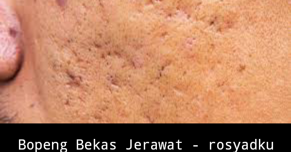 16 Cara Menghilangkan Bopeng Bekas Jerawat Secara Cepat