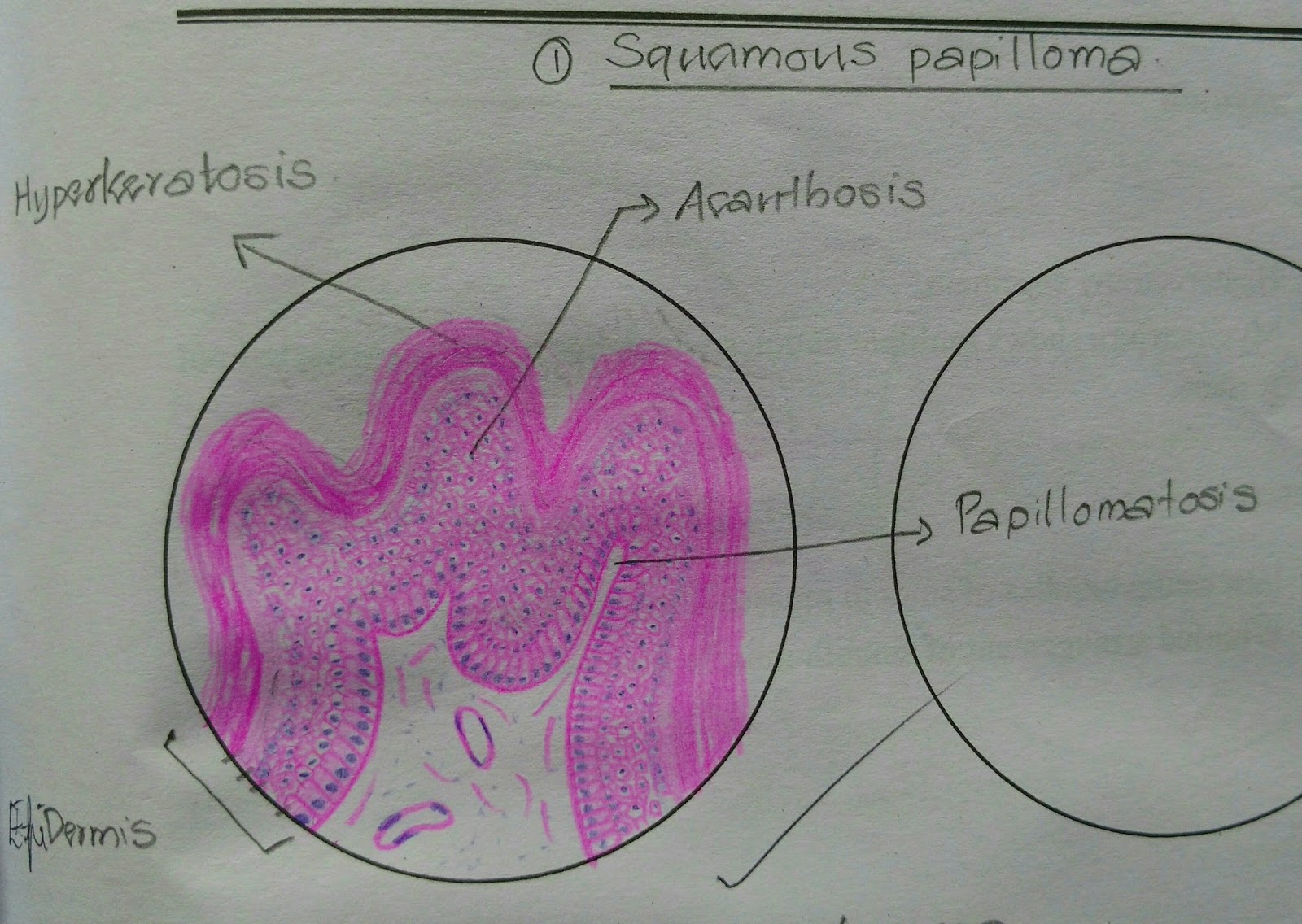 Histopathology Drawings: Squamous papilloma