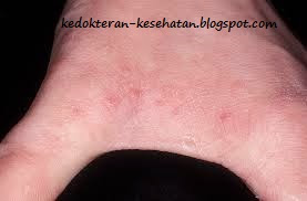 Referat Skabies : Diagnosis - KLIK INSTAL