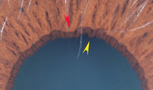 Modern & Multidimensional Iridology: IPB Frontal Indentation ...