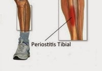 Víctor García: Periostitis Tibial