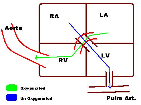 MedicoNotebook: Transposition of the Great Arteries (TGA)