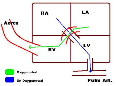 MedicoNotebook: Transposition of the Great Arteries (TGA)