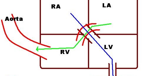 MedicoNotebook: Transposition of the Great Arteries (TGA)