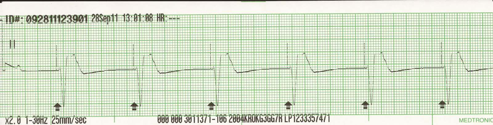 Pediatric Advance Life Support: Unstable Bradycardia