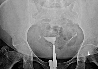 Possible Tubercular Salpingitis-HSG - Sumer's Radiology Blog