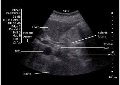 Adult Emergency Medicine: Abdominal Aorta Ultrasound