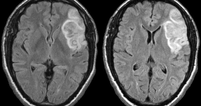 Dr Balaji Anvekar FRCR: Ischemic stroke and Vascular territories of Brain