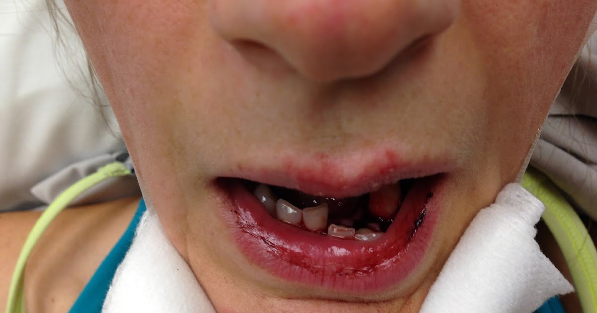 My Broken Jaw Trauma: Treatment Plan (or lack thereof)