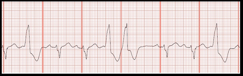 EKG Rhythm Strip Quiz 136