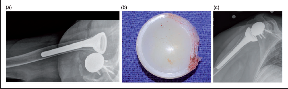 UW Shoulder and Elbow Academy: The dislocated reverse total shoulder
