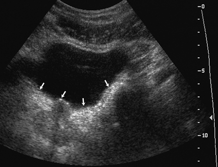 Abdominal Section: Twinkle artifact and bladder calcification