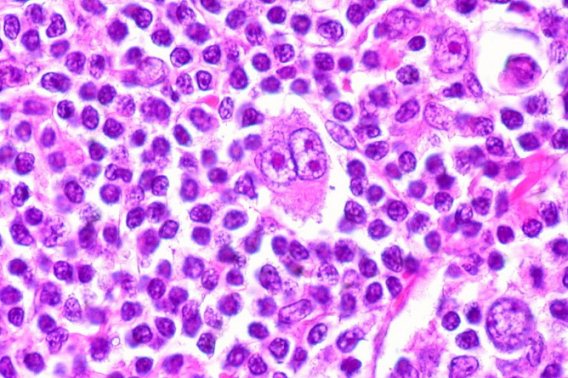 Stage 4 Hodgkin's Lymphoma Cancer