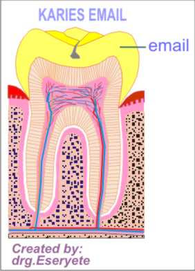 PDGI CABANG WONOGIRI: APA YANG ANDA KETAHUI TENTANG KARIES GIGI?