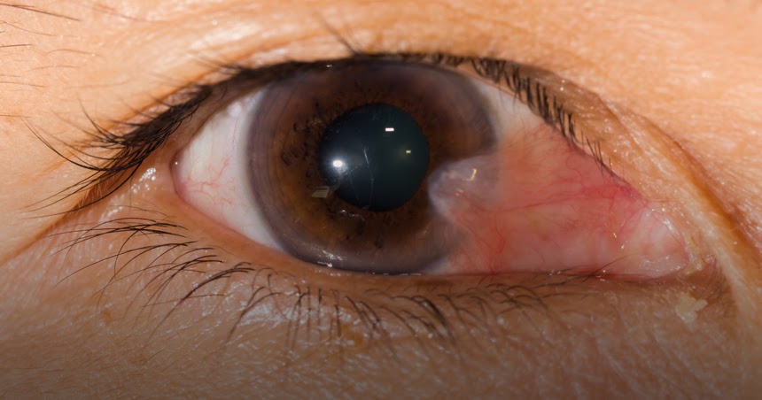 Solo para tus Ojos : ¿Es peligroso tener un pterigión - carnosidad en ...