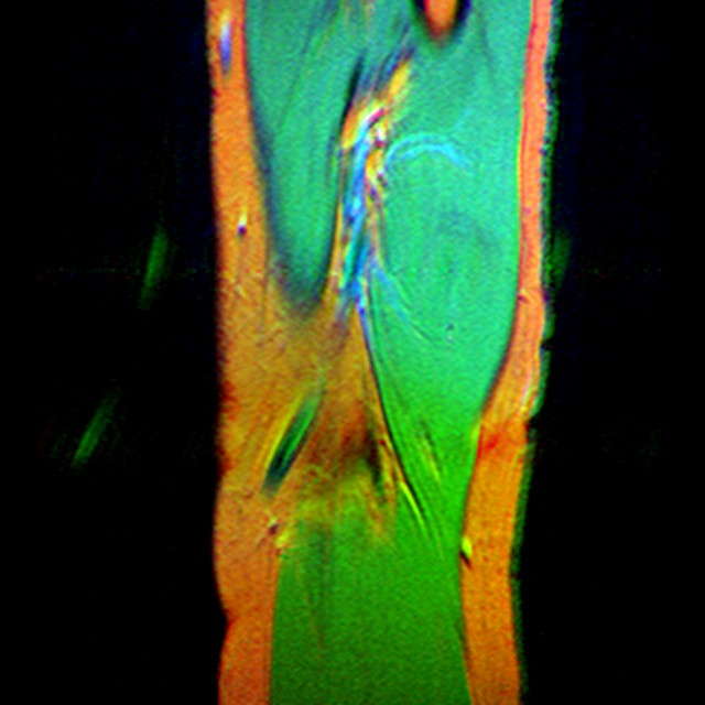 Popeye Elbow Swelling