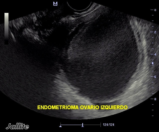 Endometrioma