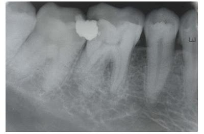 WizDent: Condensing Osteitis